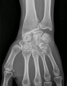 L'arthrose du poignet - Centre Main Sud Loire