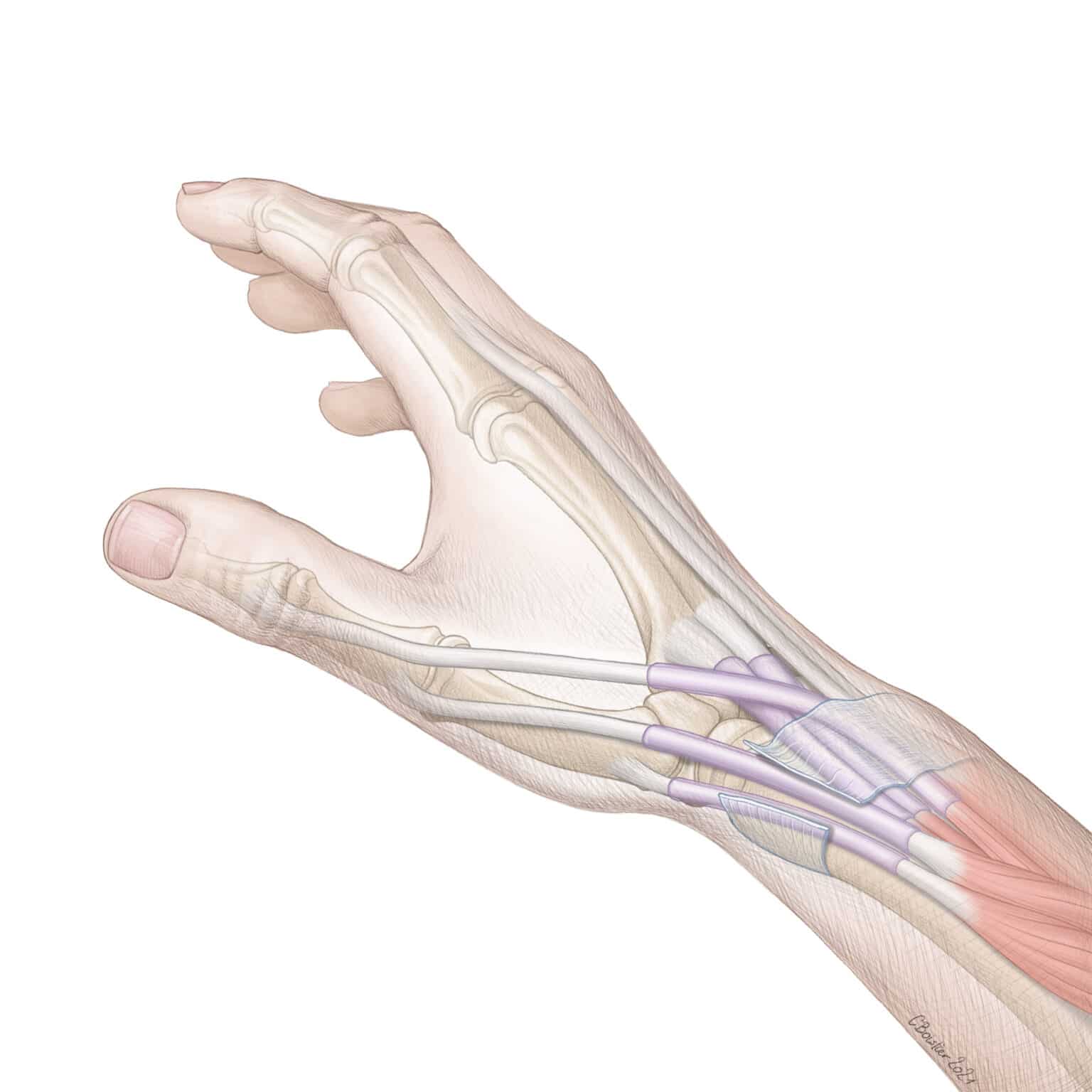 Ténosynovite de De Quervain ouverture du premier compartiment - Centre ...